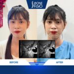 Cận cảnh hiệu quả cực đỉnh sau lần đầu thực hiện phương pháp điều trị ...